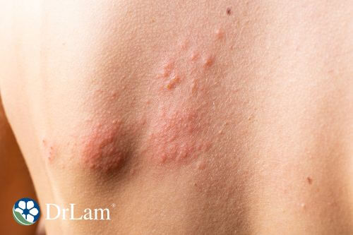 Can You Have An Allergic Reaction to B Vitamins? | Dr. Lam