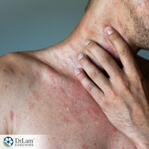 Herxheimer Reaction: What It Is And What To Do About It | Dr. Lam