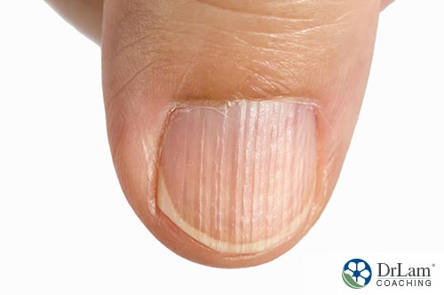 Vertical Lines On Fingernails May Indicate Certain Health Issues